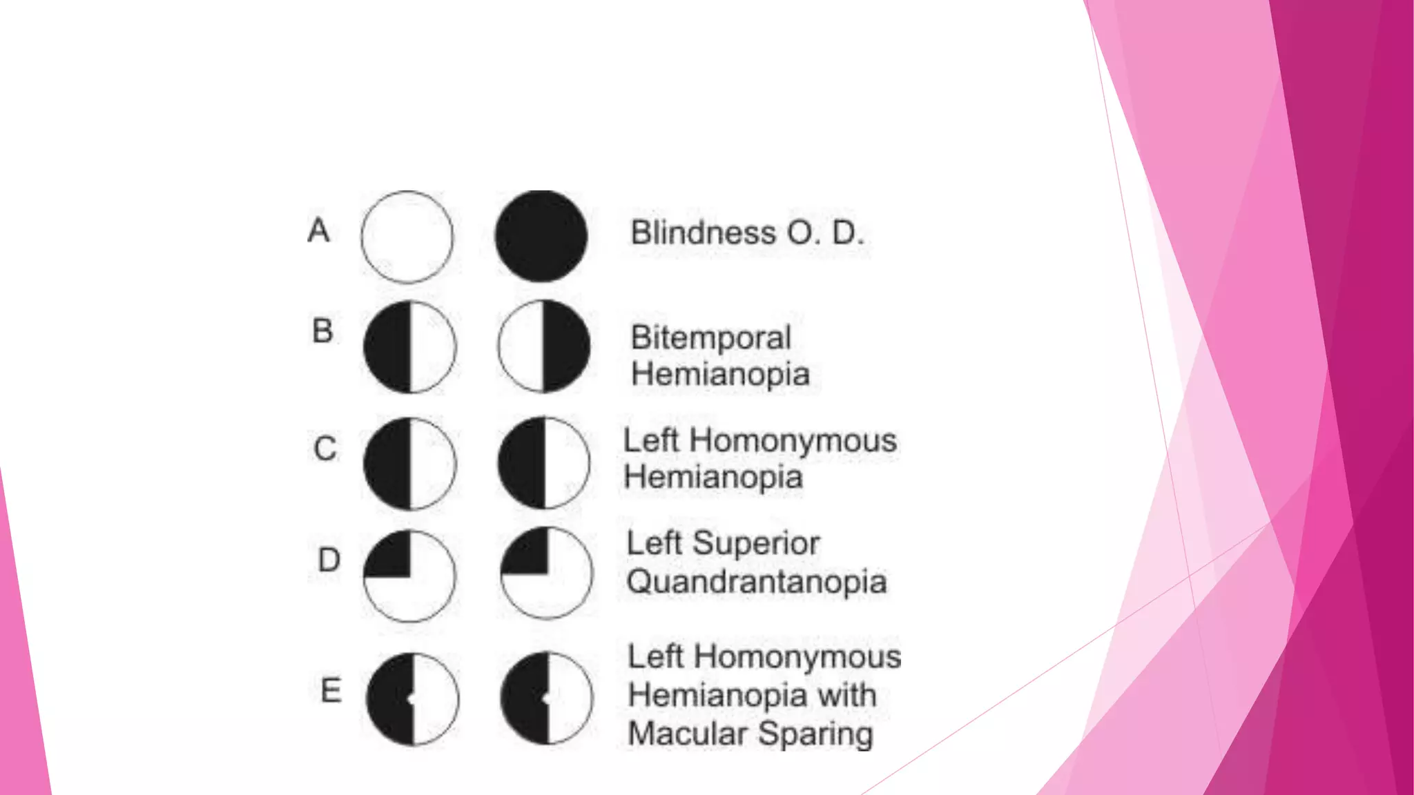 Basic approach on hvf | PPTX