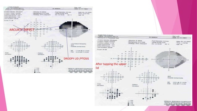 Basic approach on hvf | PPTX