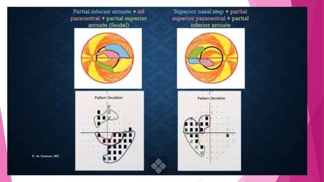 Basic approach on hvf | PPTX