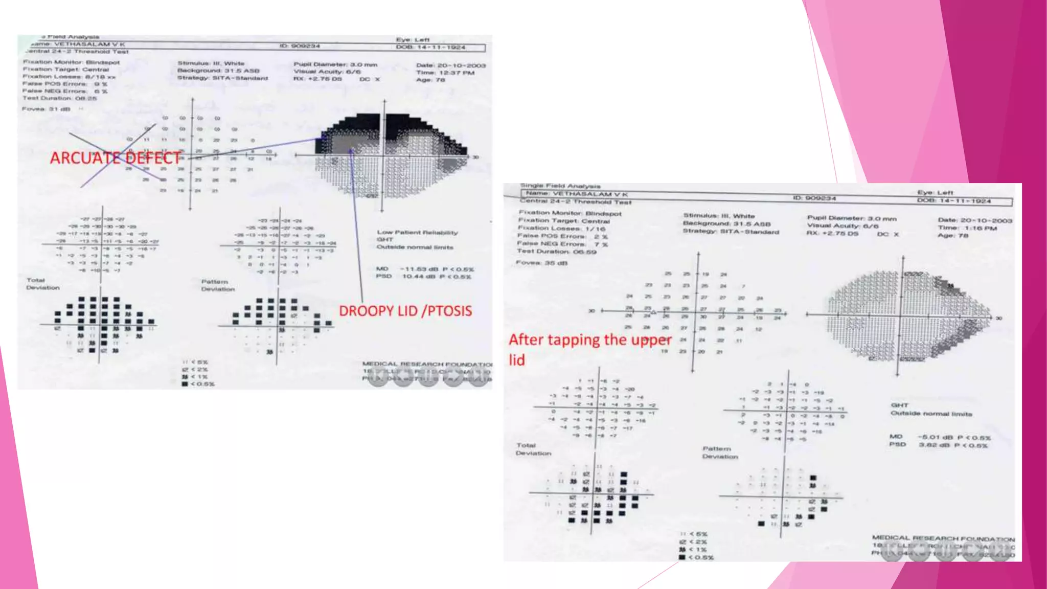 Basic approach on HVF | PPTX