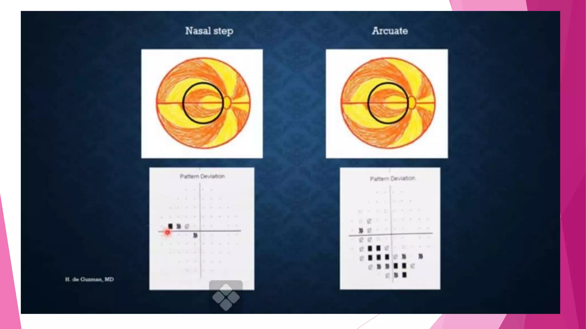 Basic approach on HVF | PPTX