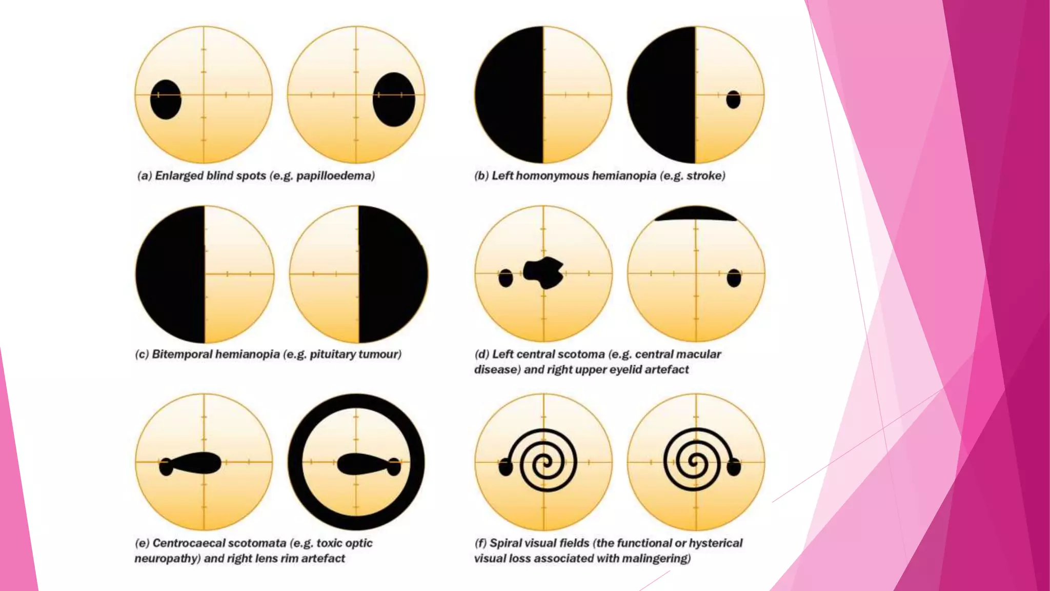 Basic approach on HVF | PPTX