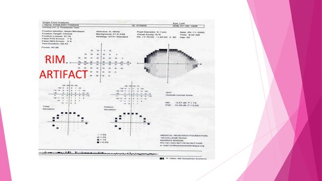 Basic approach on HVF | PPTX | Eye and Vision Conditions | Diseases and ...