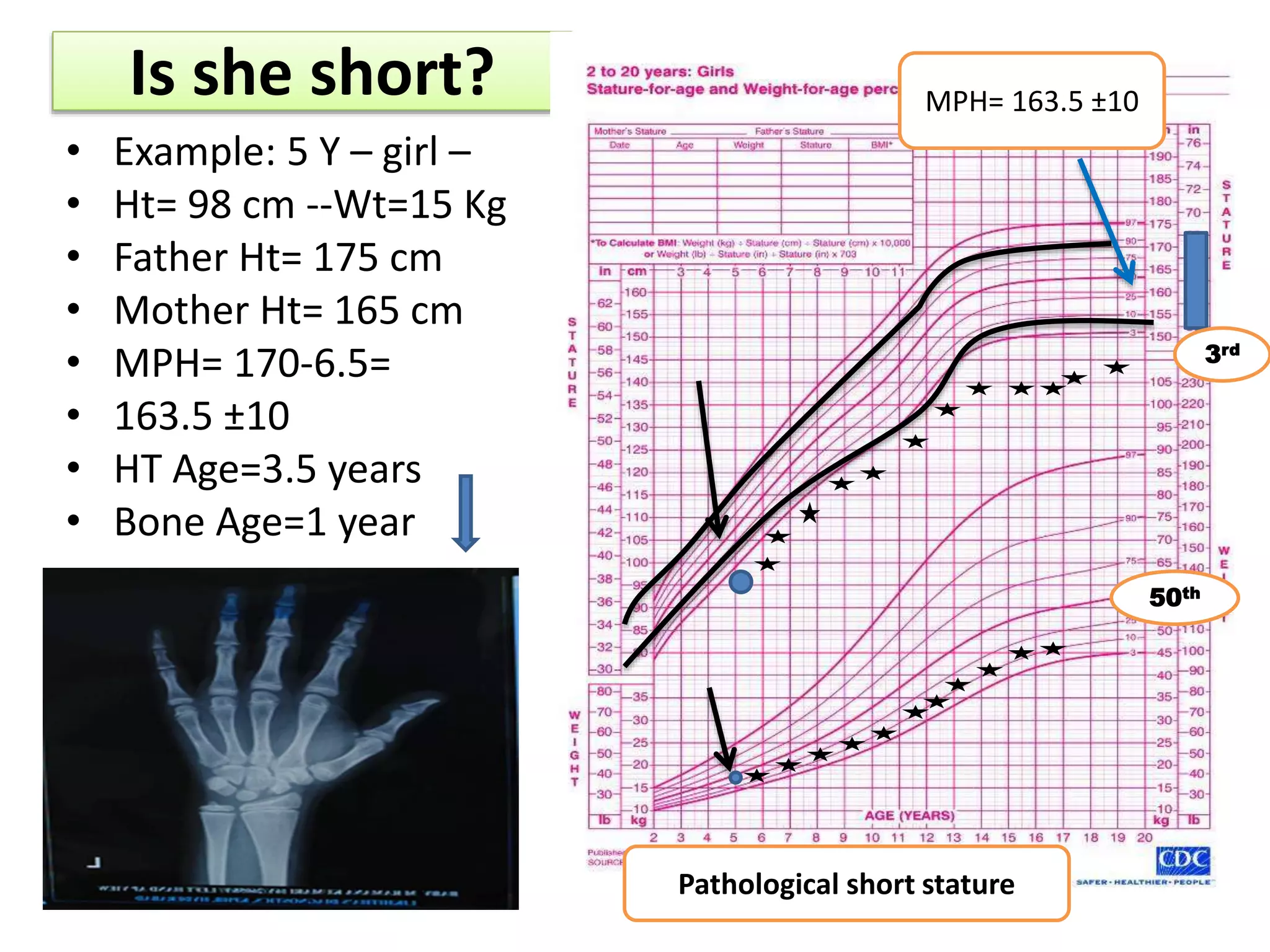 Basic approach on short stature in children | PPTX