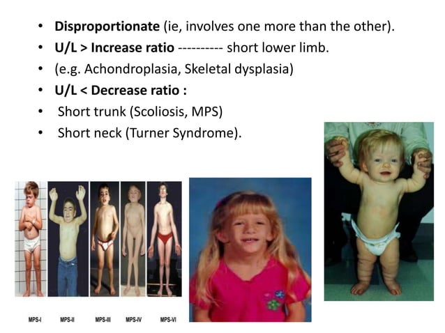 Basic approach on short stature in children | PPT