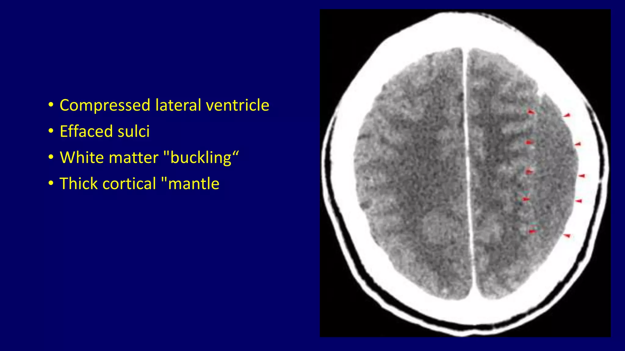 Basic approach to brain CT Dr. Muhammad Bin Zulfiqar | PPTX