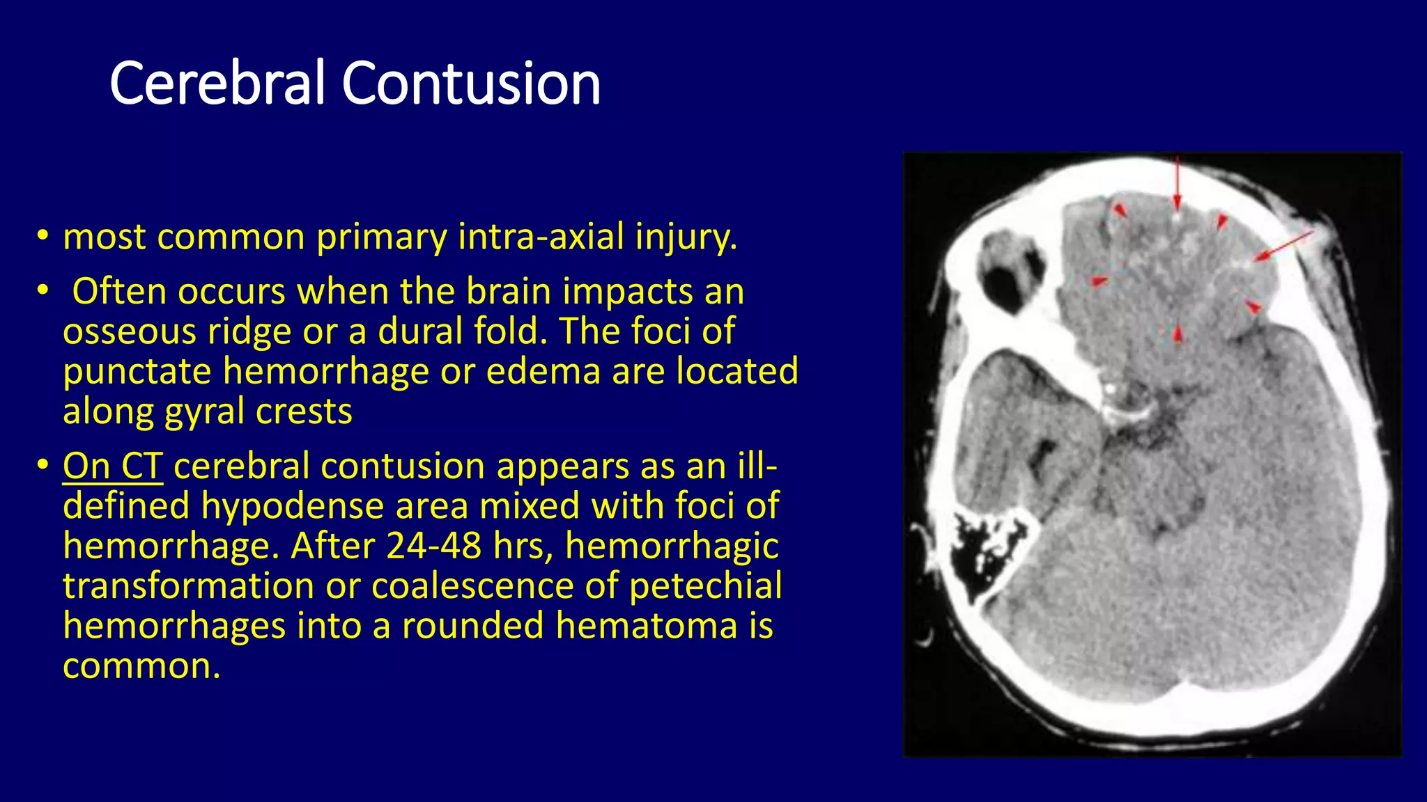 Basic approach to brain CT Dr. Muhammad Bin Zulfiqar | PPTX