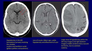 Basic approach to brain CT Dr. Muhammad Bin Zulfiqar | PPTX