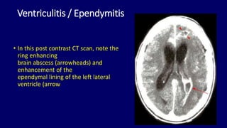 Basic approach to brain CT Dr. Muhammad Bin Zulfiqar | PPTX