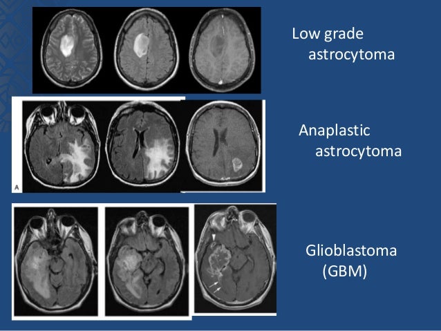 Basic approach to brain tumor