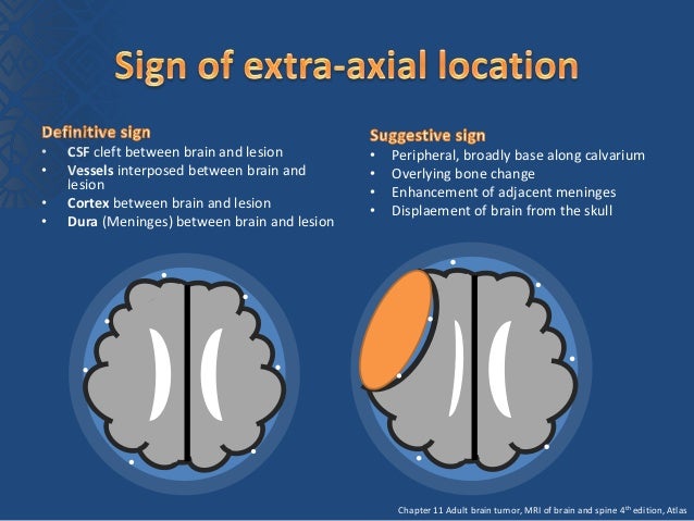 Basic approach to brain tumor