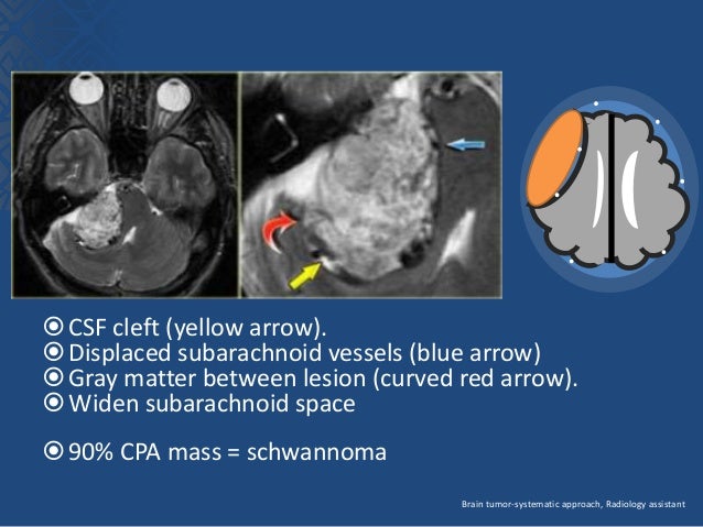 Basic approach to brain tumor