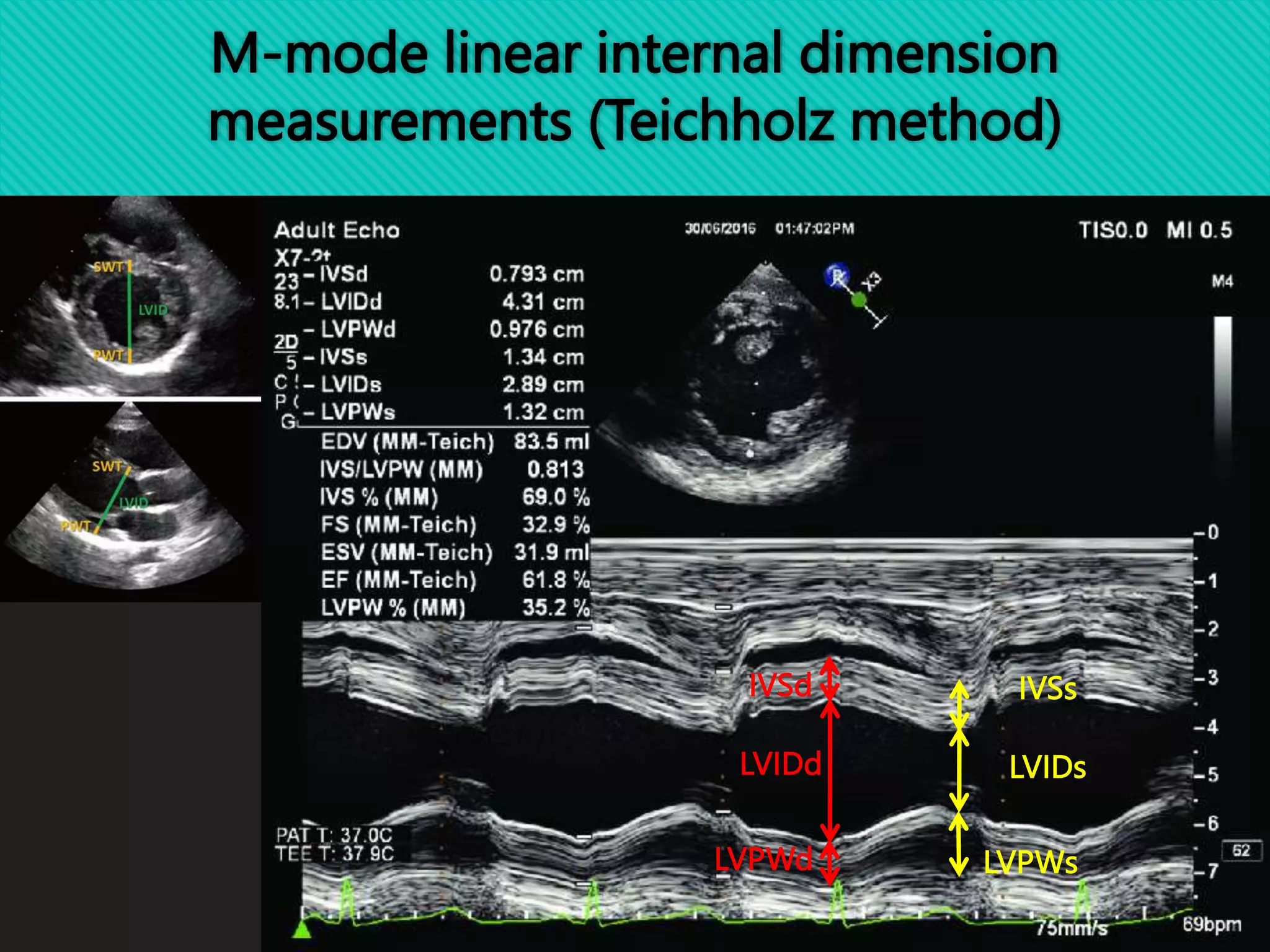 BASIC CARDIAC US.pptx