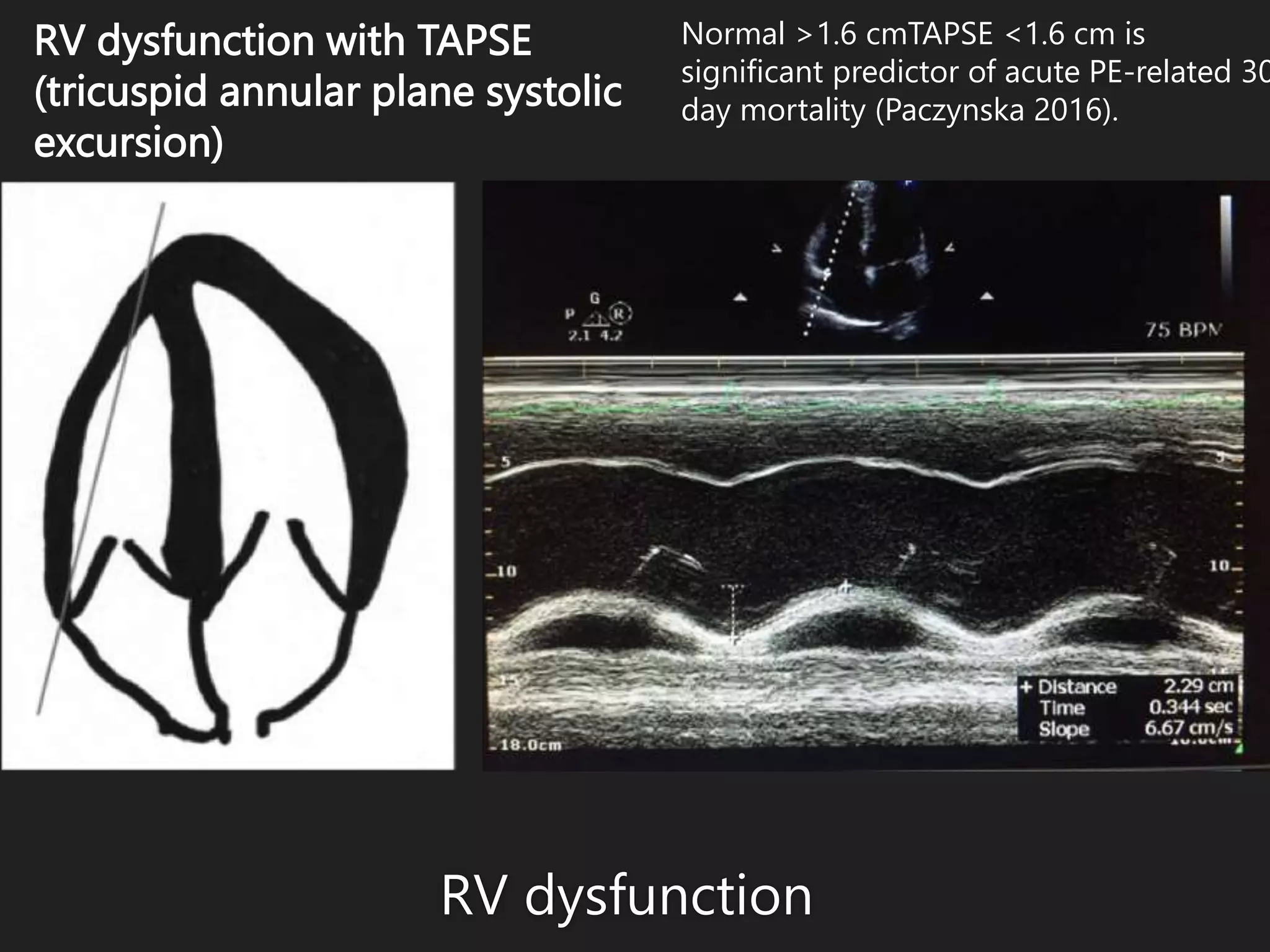 BASIC CARDIAC US.pptx | Heart and Cardiovascular Diseases | Diseases ...