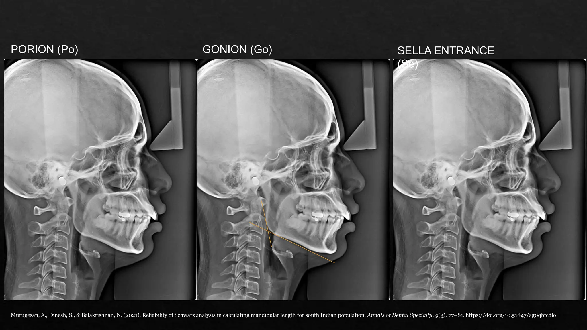 BASIC CEPHALOMETRY.pptx