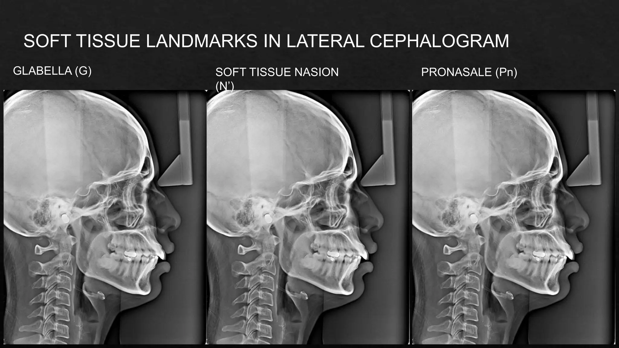 BASIC CEPHALOMETRY.pptx