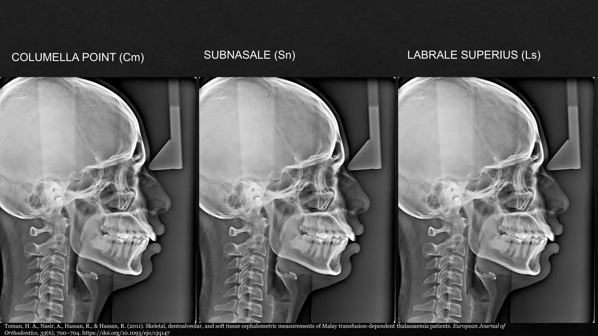 BASIC CEPHALOMETRY.pptx
