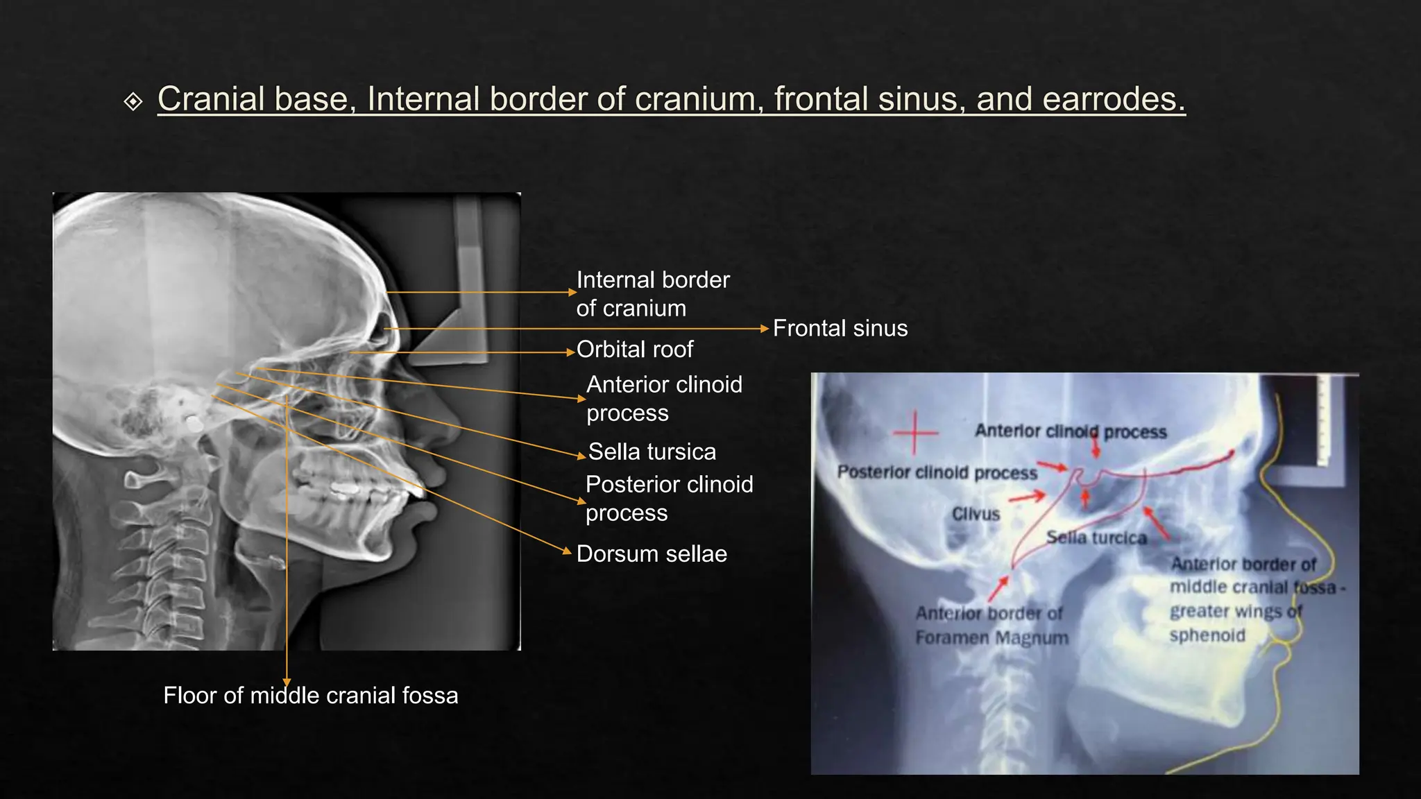 BASIC CEPHALOMETRY.pptx