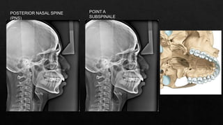 BASIC CEPHALOMETRY.pptx