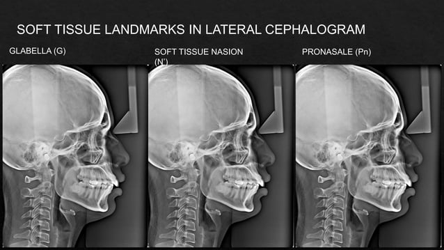 BASIC CEPHALOMETRY.pptx