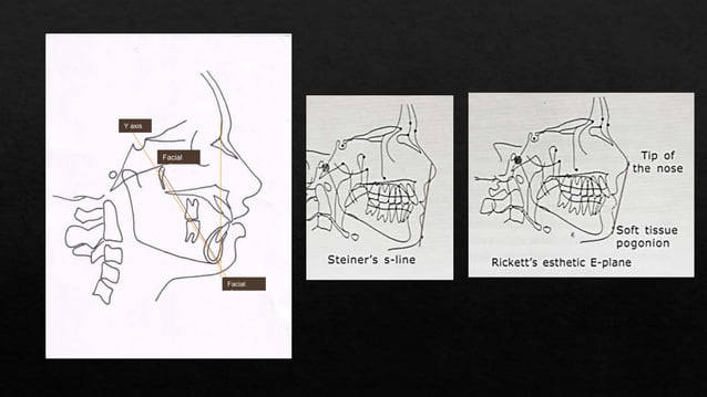 BASIC CEPHALOMETRY.pptx