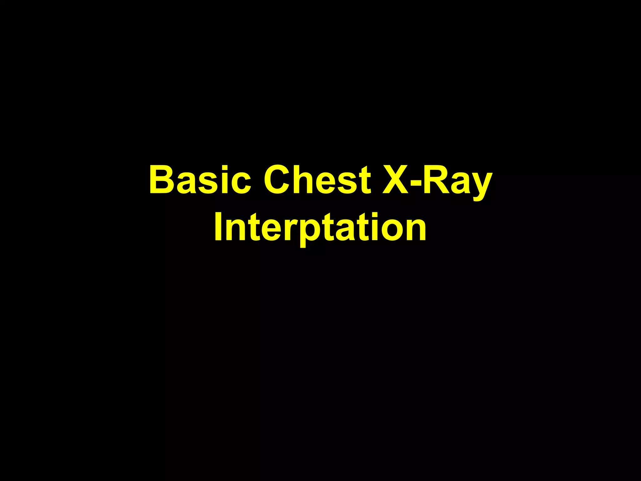 Basic chest x ray interpretation | PPT