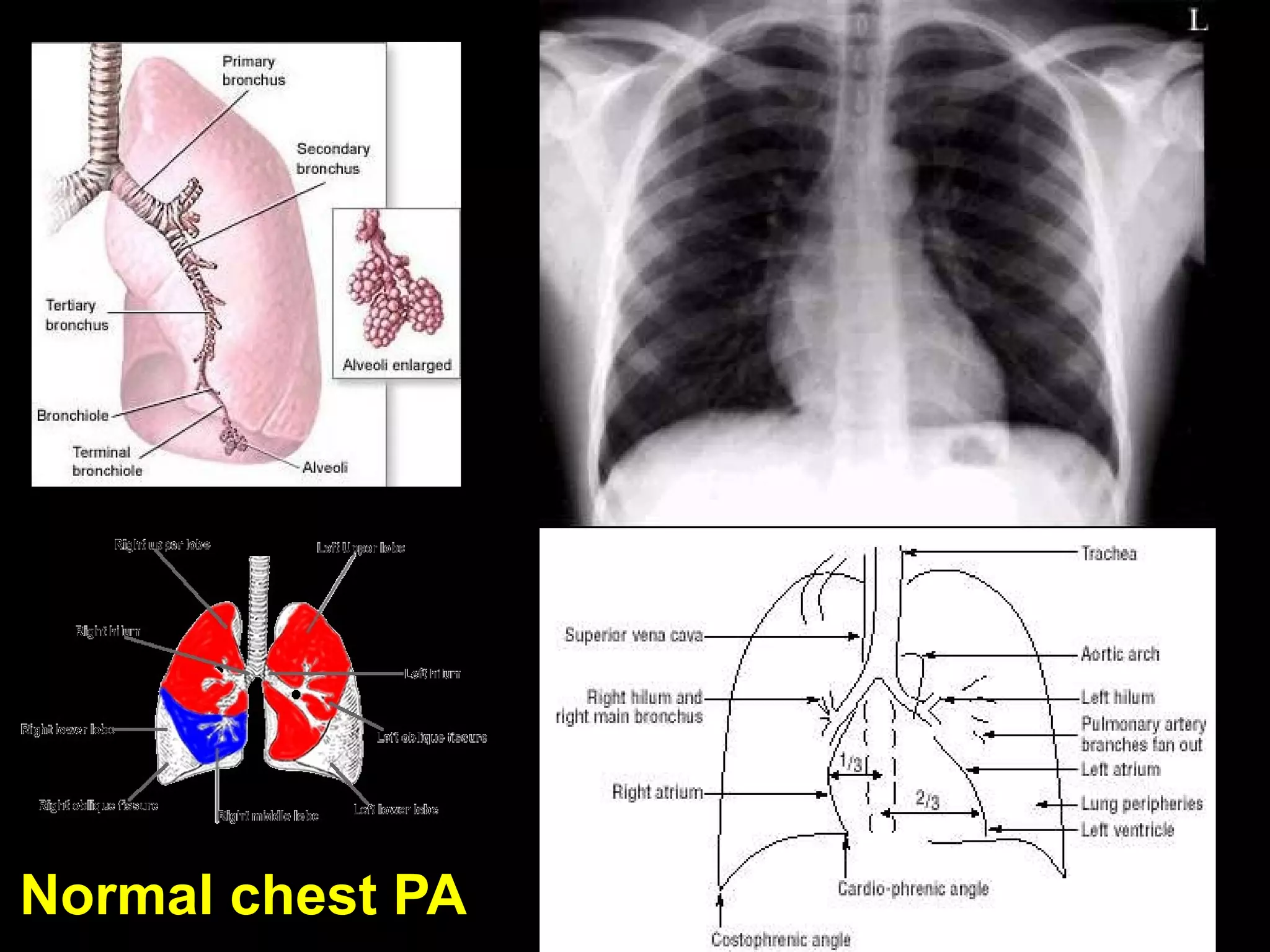 Basic chest x ray interpretation | PPT