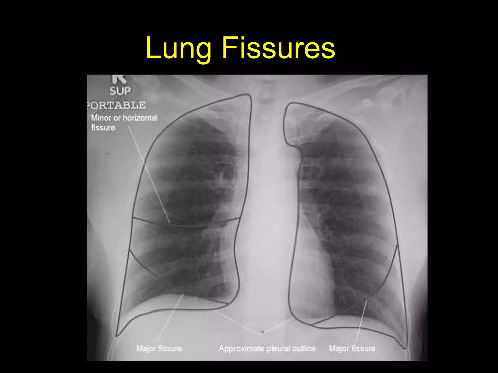 Basic chest x ray interpretation | PPT