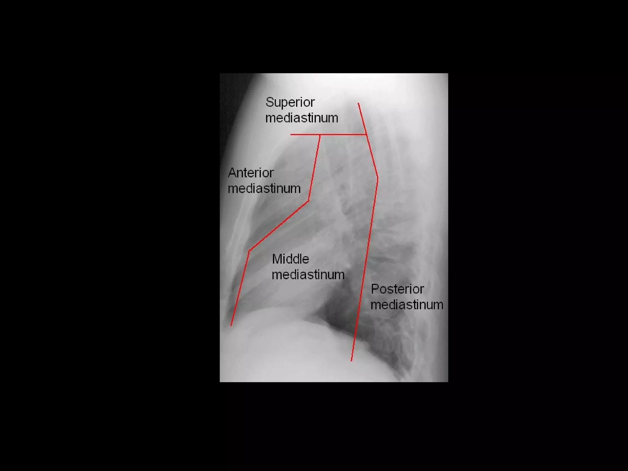 Basic chest x ray interpretation | PPT