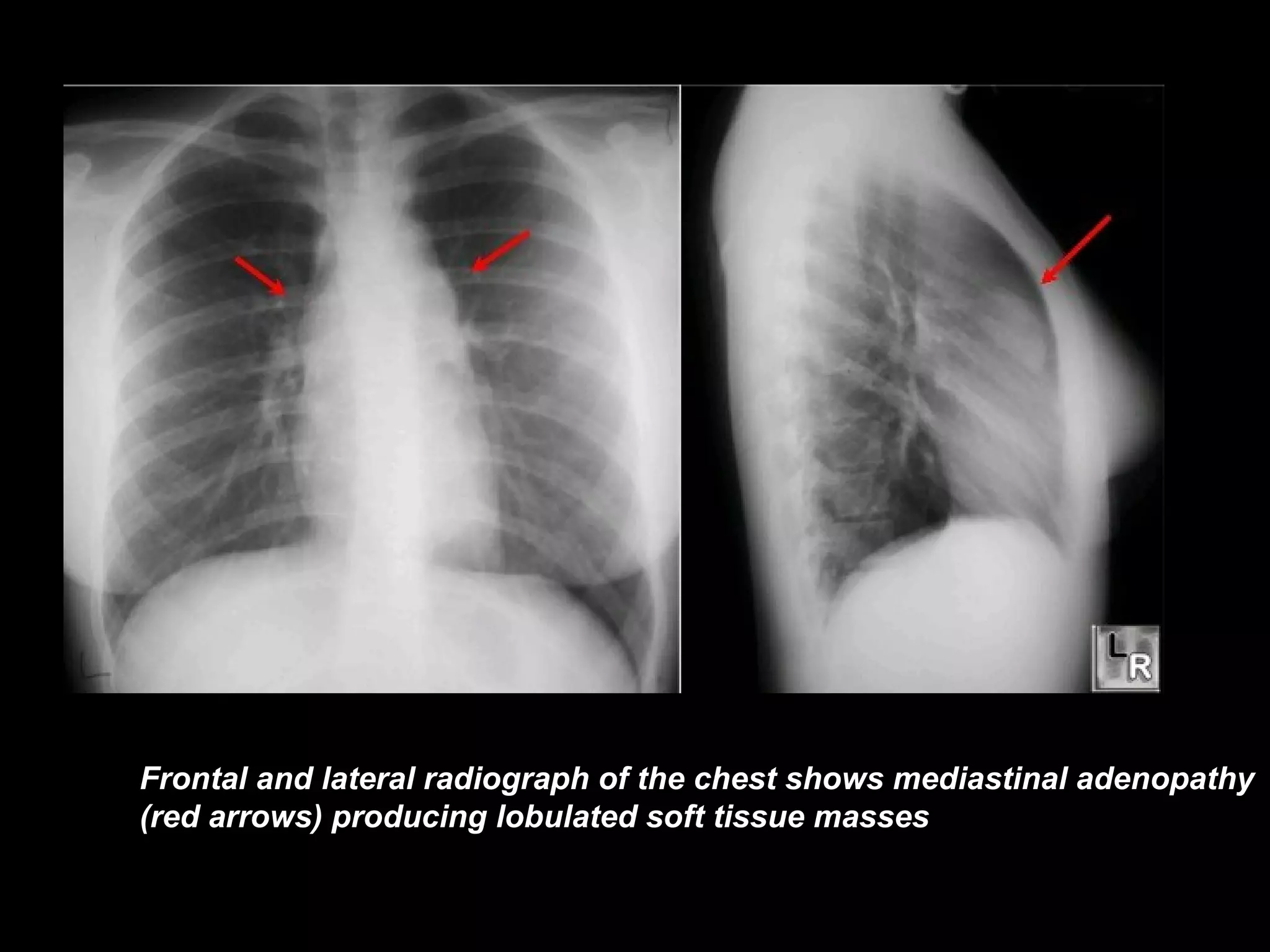 Basic chest x ray interpretation | PPT