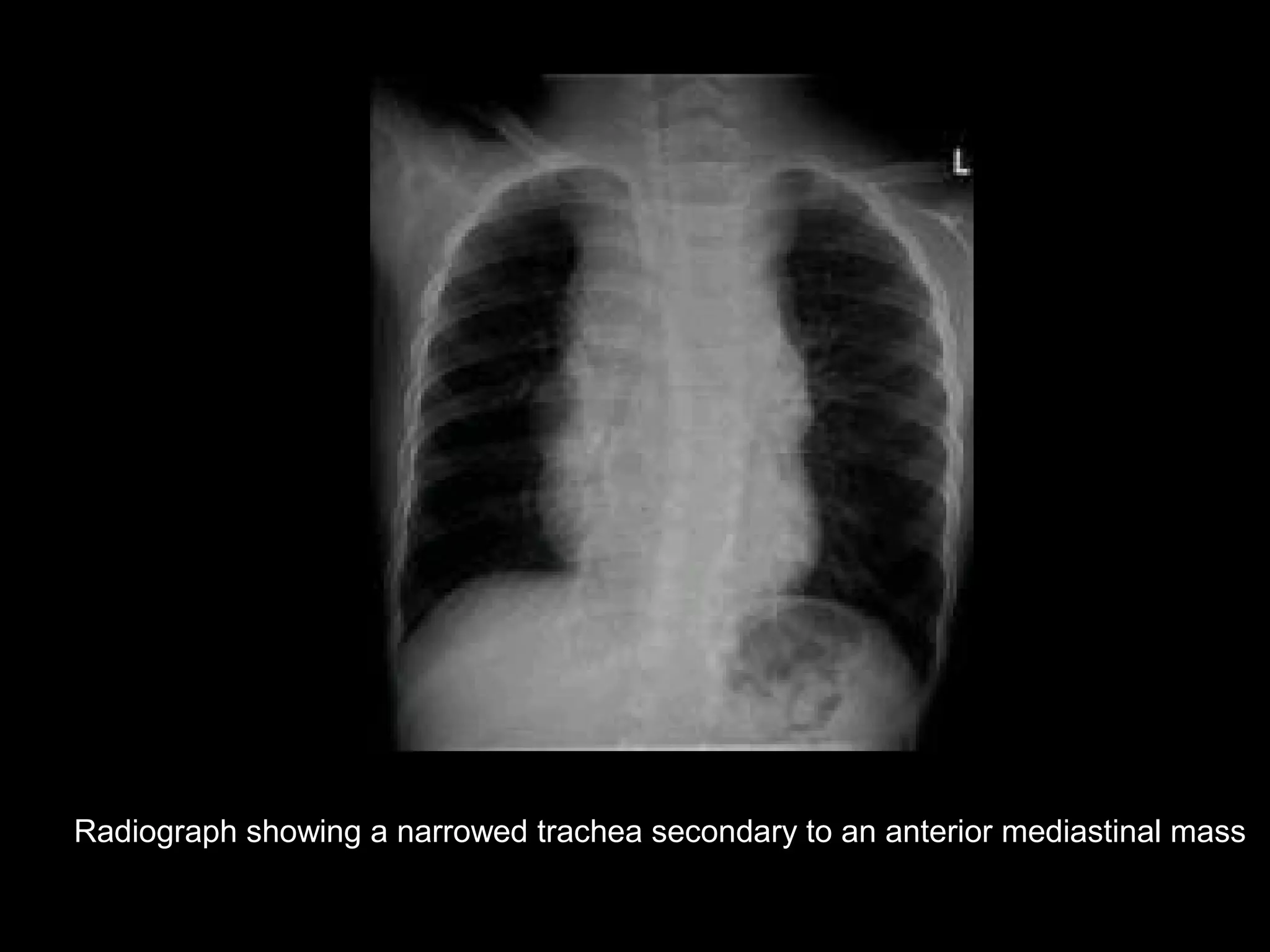 Basic Chest X Ray Interpretation Ppt