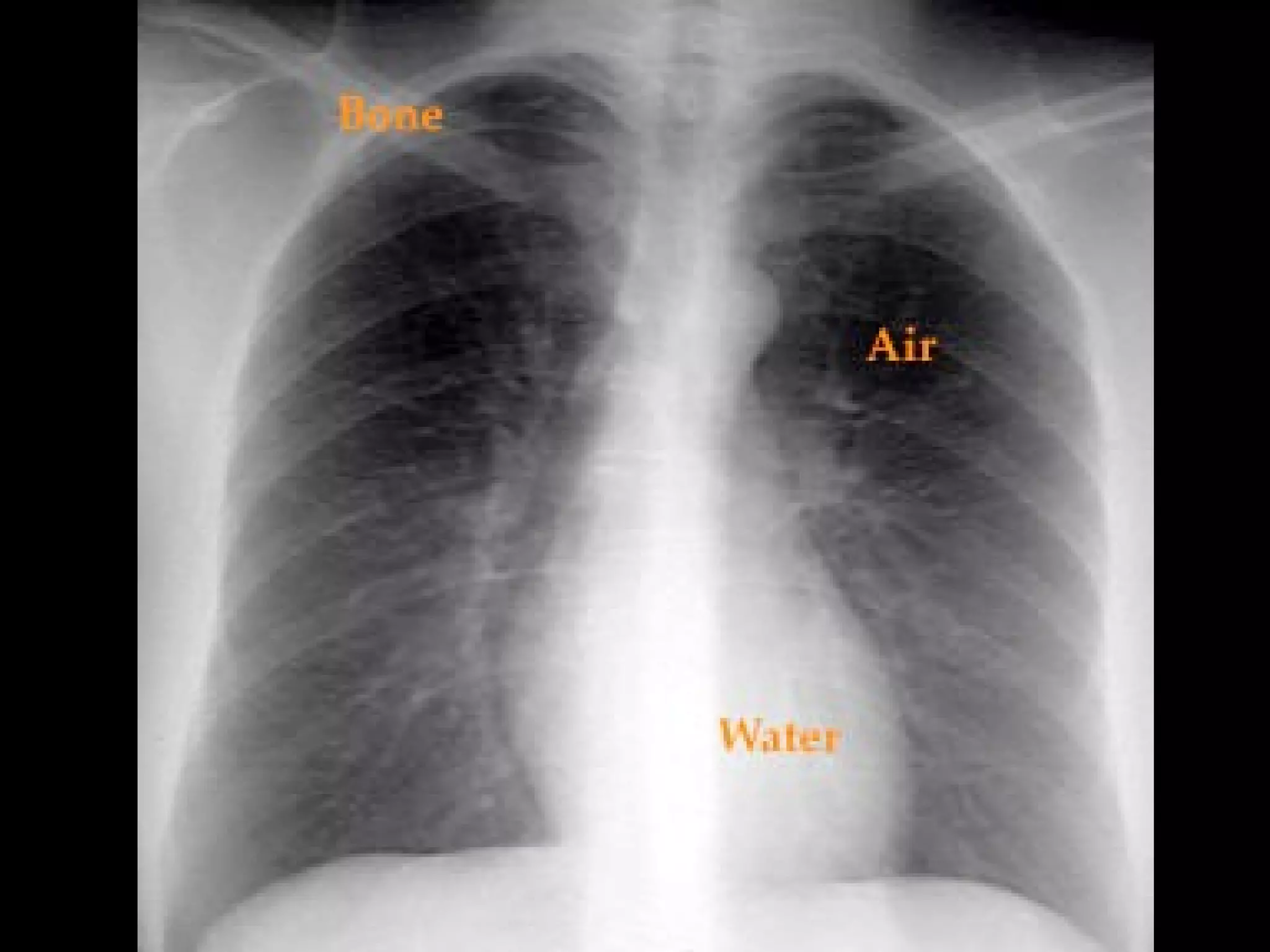 Basic chest x ray interpretation | PPT