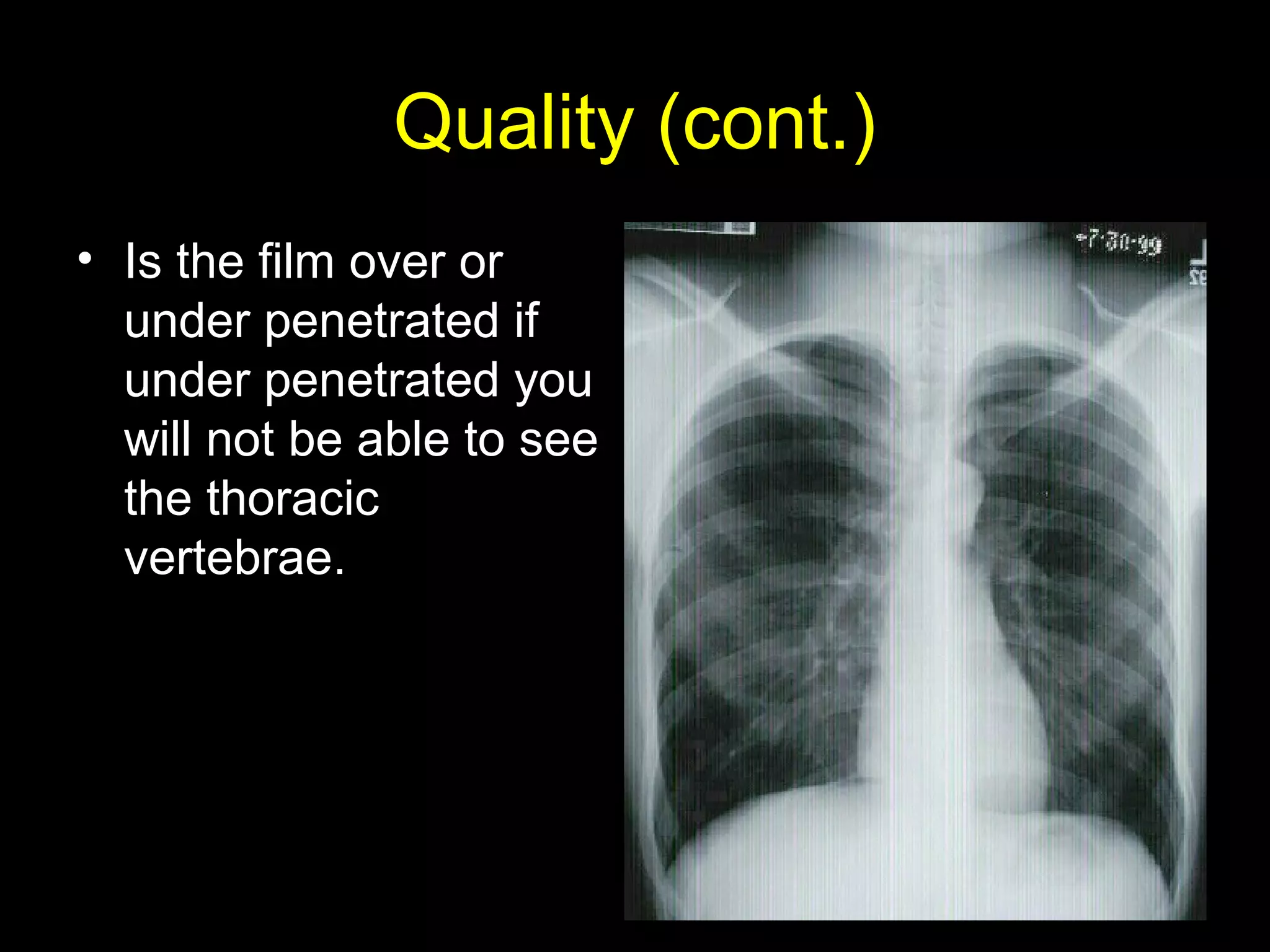 Basic chest x ray interpretation | PPT