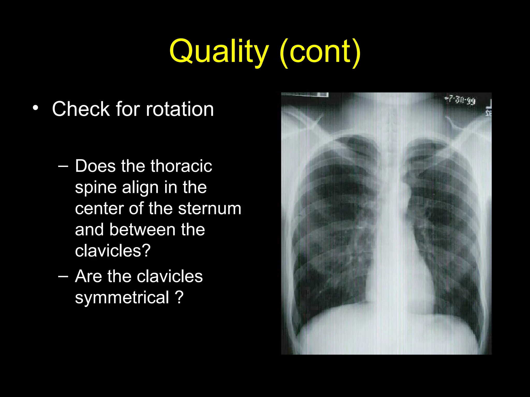 Basic chest x ray interpretation | PPT