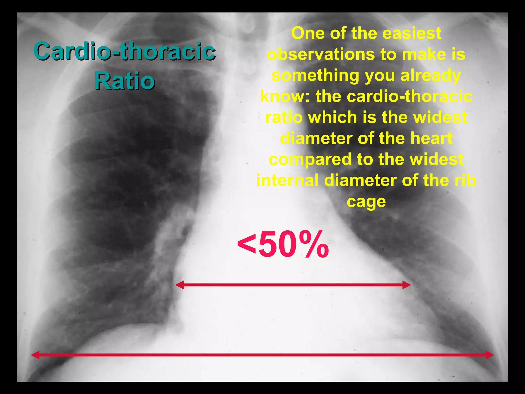 Basic chest x ray interpretation | PPT