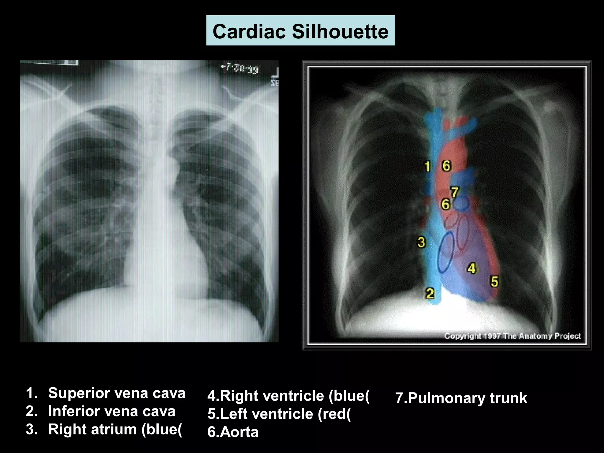 Basic chest x ray interpretation | PPT