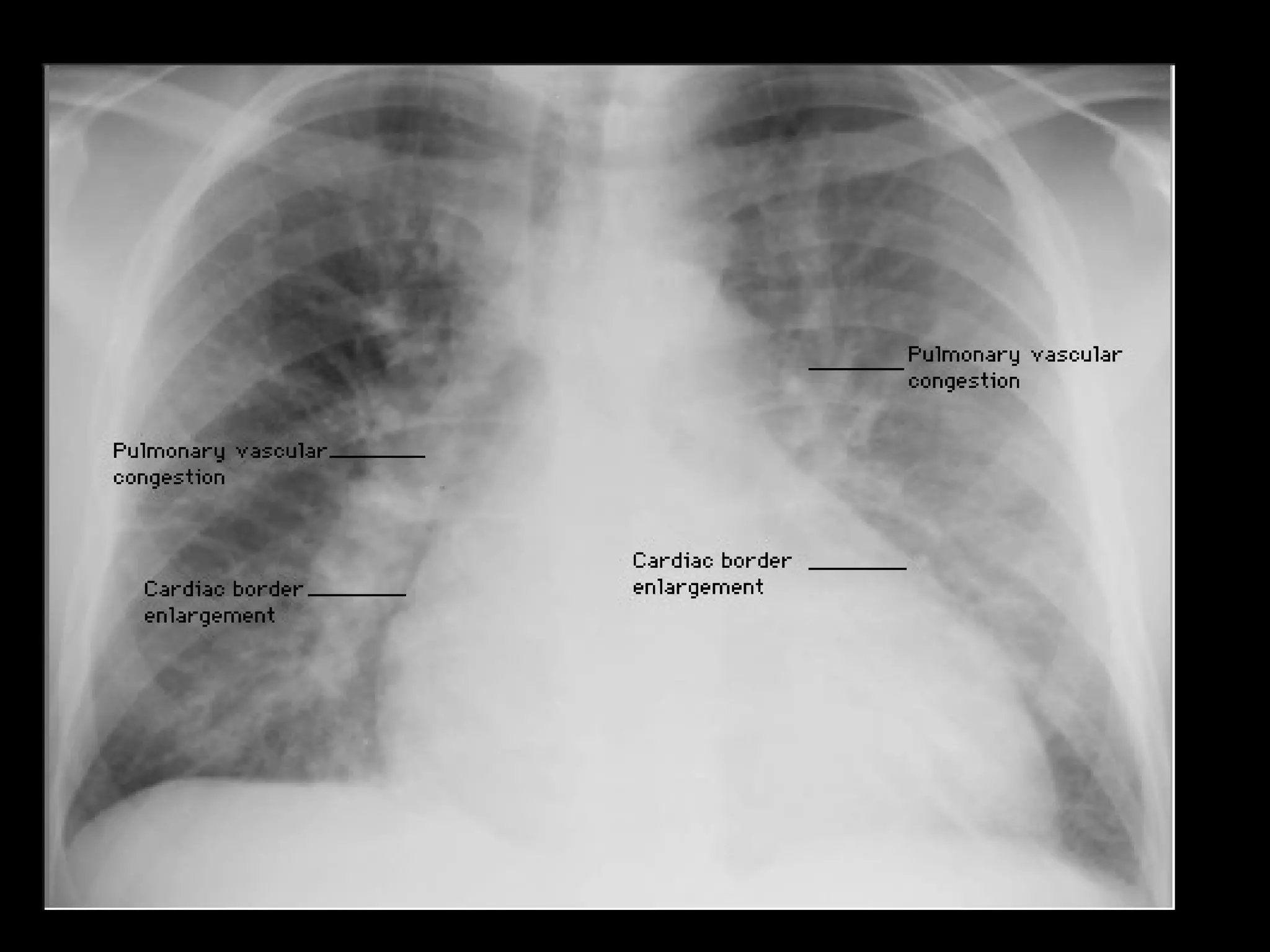 Basic chest x ray interpretation | PPT
