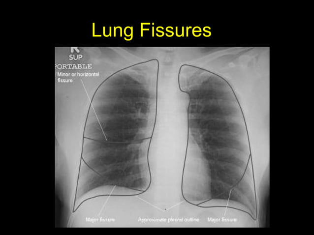 Basic chest x ray interpretation | PPT