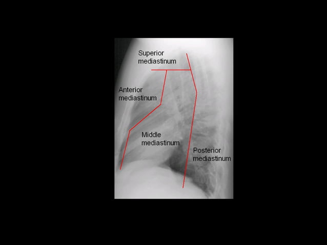 Basic chest x ray interpretation | PPT