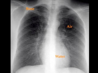 Basic chest x ray interpretation | PPT