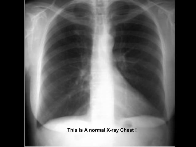 Basic chest x ray interpretation | PPT