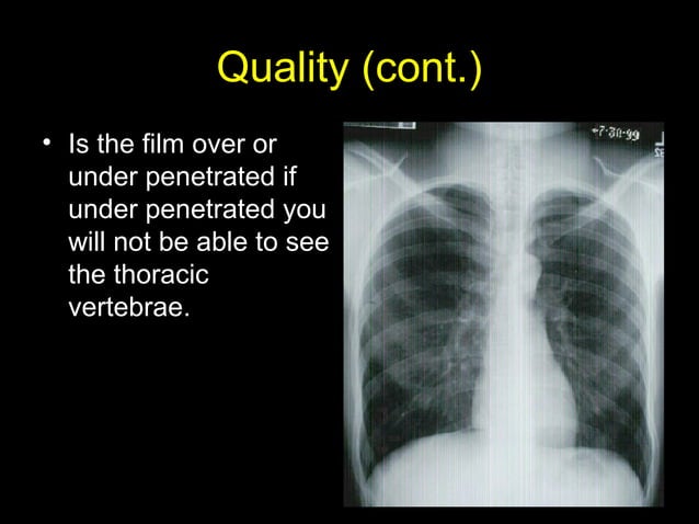 Basic chest x ray interpretation | PPT