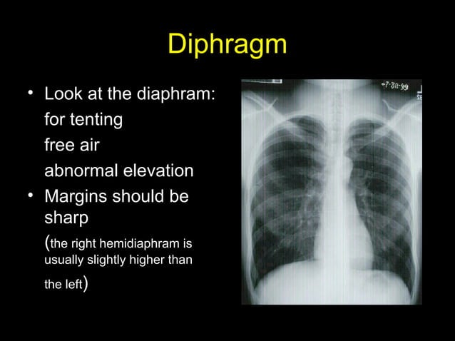 Basic chest x ray interpretation | PPT