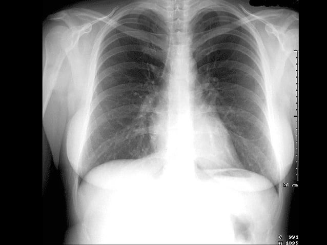 Basic chest x ray interpretation | PPT