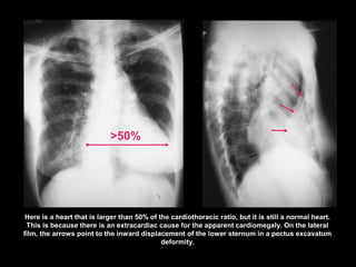 Basic chest x ray interpretation | PPT