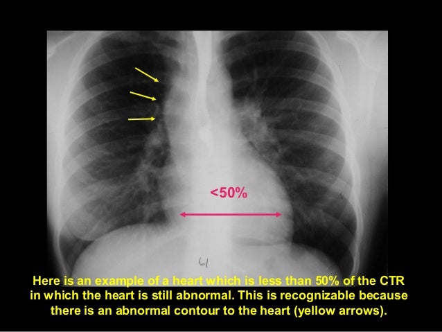 Basic chest x ray interpretation