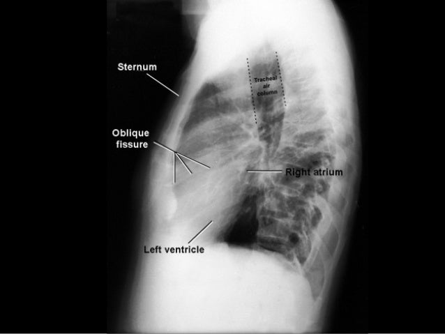 Basic chest x ray interpretation