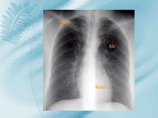 bbbbbbasic chest x-ray interpretation.ppt