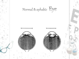 Aphakia,Causes ,Symptoms,signs,treatment | PPTX