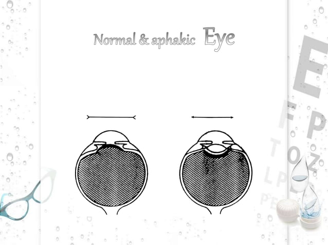 Aphakia,Causes ,Symptoms,signs,treatment | PPTX